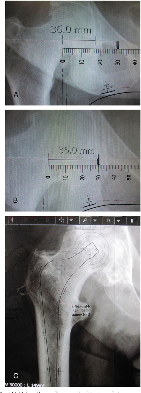 Figure From Scaling Digital Radiographs For Templating In Total Hip