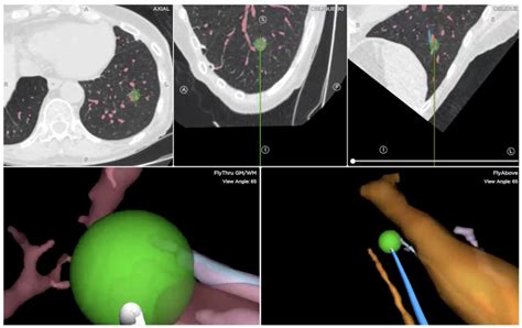 Representative Screen Capture During Electromagnetic Navigational