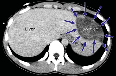 Liver Puncture During Epicardial Access Attempt Resulting In A