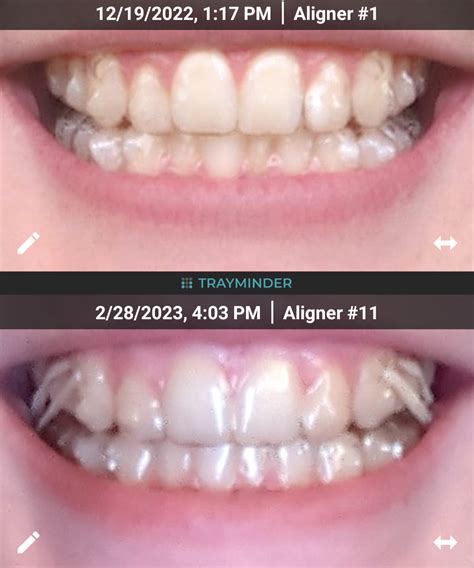 Halfway Done With My First Set Of Aligners 11 23 I Cant See Much Of A Difference In My Front