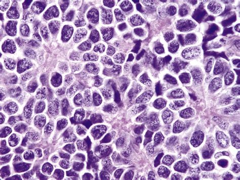 Ewing Sarcoma Hip Histology