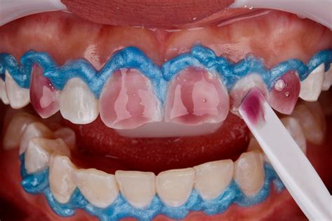 Tooth Whitening Combined Technique