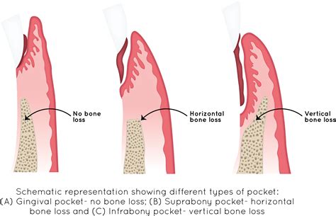 Pemeriksaan Plak Dan Kalkulus Materi Belajar Umeds