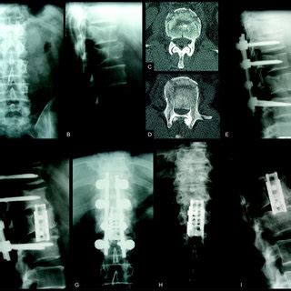 ATLS Algorithm And Spine Trauma Assessment In Step A Cervical Spine Download Scientific