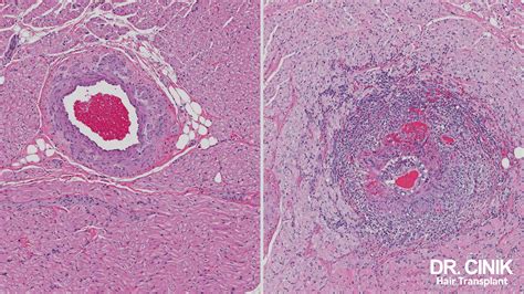 When Can I Have Sex Again After A Hair Transplant Dr Cinik