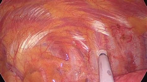 Uniportal Vats For Bullectomy Of Left Lower Lobe Youtube