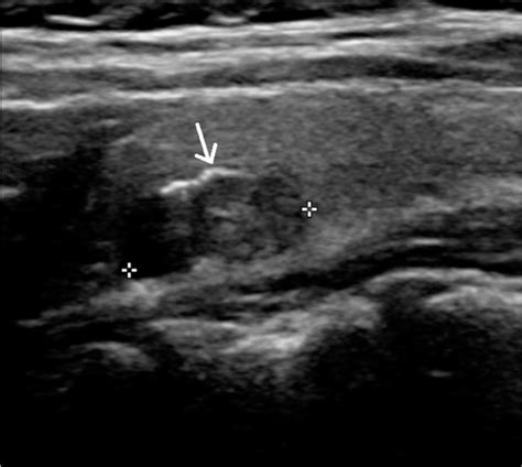 Validation Of Tirads Acr Risk Assessment Of Thyroid Nodules In Comparison To The Ata Guidelines