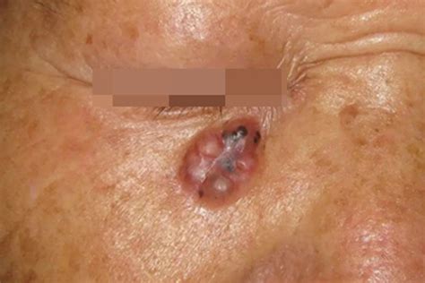 皮肤基底细胞癌面部疙瘩图片