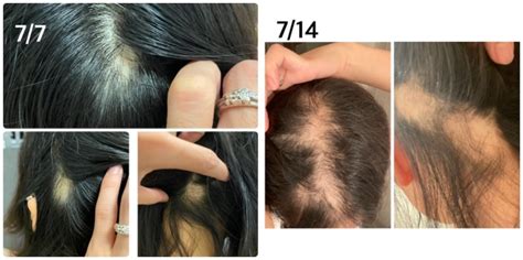 모더나 부작용은 대머리 일본 20 이미지 이투데이