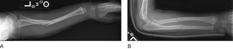 7 Forearm Fractures Closed Treatment Musculoskeletal Key