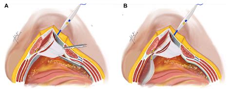 Figure 2 From Posterior Component Separation Technique—original