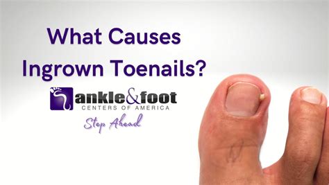Ingrown Toenail Removal What Causes Ingrown Toenails