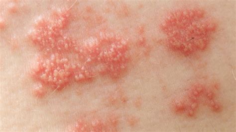 Herpes Zoster Shingles Infectious Dis Medbullets Step 23