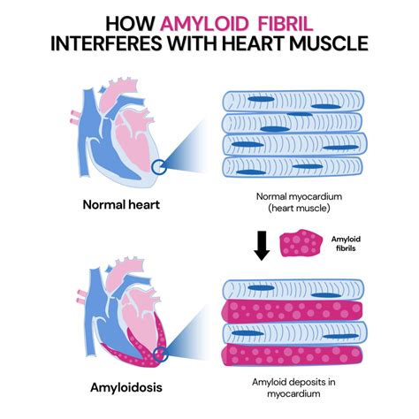 Hereditary Amyloidosis Do You Have The Genetic Risk Factors