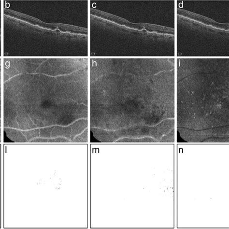 A Semi Automated Method Of Generated Intraretinal Hyperreflective Foci