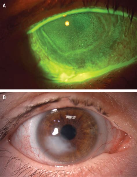 Neurotrophic Keratitis Resolution Of A Neurotrophic Keratopathy