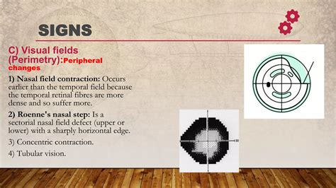 Primary Open Angle Glaucoma Pptx