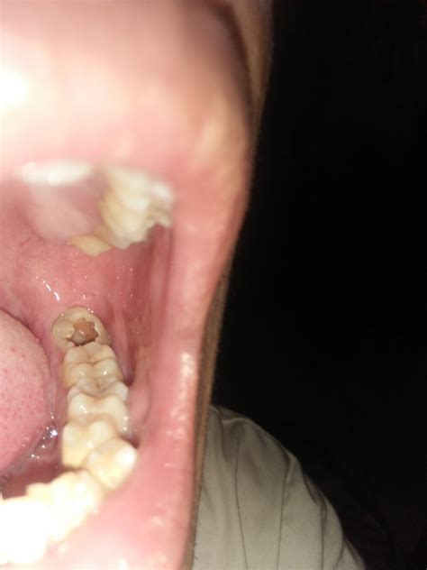 Bolehkah Gigi Sakit Dicabut Id