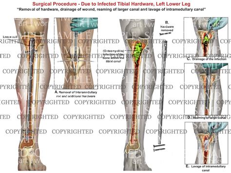 Right Tibia Intramedullary Canal Lavage Medical Art Works