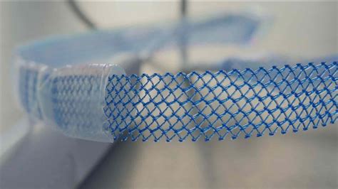 Vaginal Mesh Ban Can Be Lifted With Changes Report Star Mag