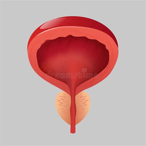 Normal Prostate And Acute Prostatitis Medical Illustration Stock Vector Illustration Of