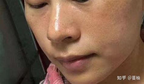 色斑为何难以消除？关键在于你有没有做对 知乎