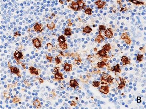 Cd1a⁺ Dcs A B And Cd66b⁺ Neutrophils C D In The Sections Of