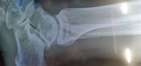 关于我腓骨远端骨折这件事 知乎