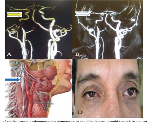 Figure 1 From Horners Syndrome Due To A Spontaneous Internal Carotid