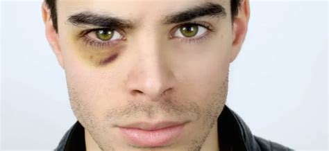 The Case Is Dark The Causes Of Bruising Under The Eyes Healthy Food