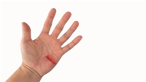 67100 Cut Finger Fotografías De Stock Fotos E Imágenes Libres De