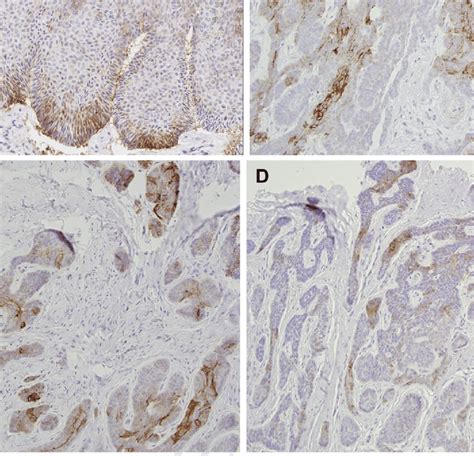A C Ber Ep4 Immunohistochemistry Ihc Demonstrating Focal Patchy