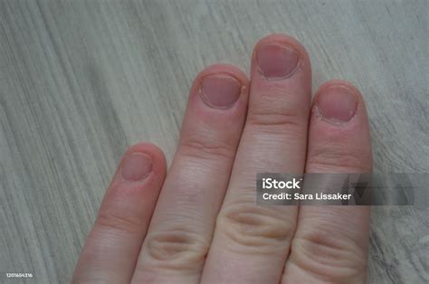 피부 따기에서 손상된 큐피클을 가진 불안 무질서 때문에 물기에서 손상된 손톱 피부과 성 조 난 및 부 어 와 핑크 스트레스에 대 한 개념 우울증 또는 의료 목적 강박에 대한