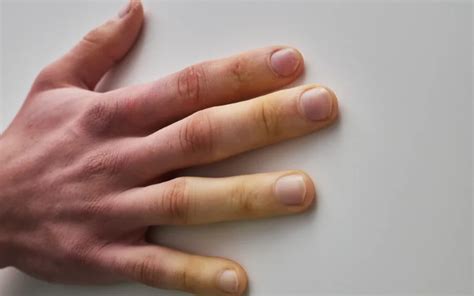 Recognizing And Handling Scleroderma Symptoms