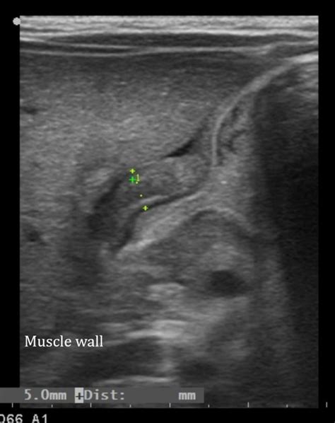 Pyloric Stenosis Ultrasound