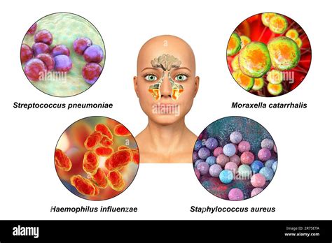 Anatomy Of Rhinosinusitis And Bacteria That Cause Sinusitis