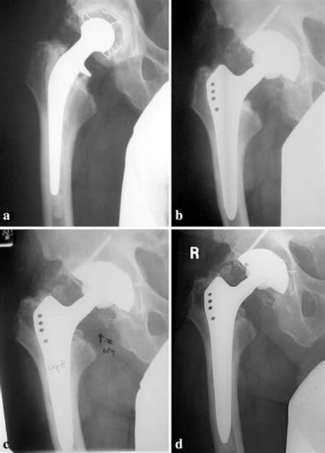 Ap Pre Revision Radiograph B Post Operative Radiograph Of Revision