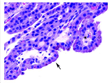 A Case Of Papillary Hyperplastic Nodule On High Power Showing Download Scientific Diagram