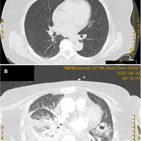 Figure E Thoracic Computerized Tomography Scan Before And After Download Scientific Diagram