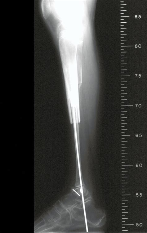 Tibialization Of The Distal Fibula Oncosurgery