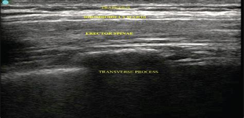 Ultrasound Guided Erector Spinae Plane Block For Postoperati