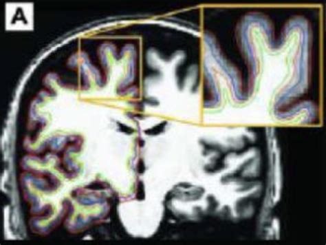 Looking For Command To Expandshrink Freesurfer Surfaces Software