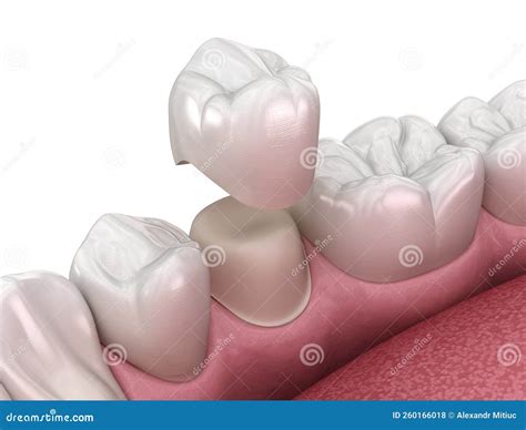 Preparated Premolar Tooth And Ceramic Crown Placement Medically Accurate 3d Illustration