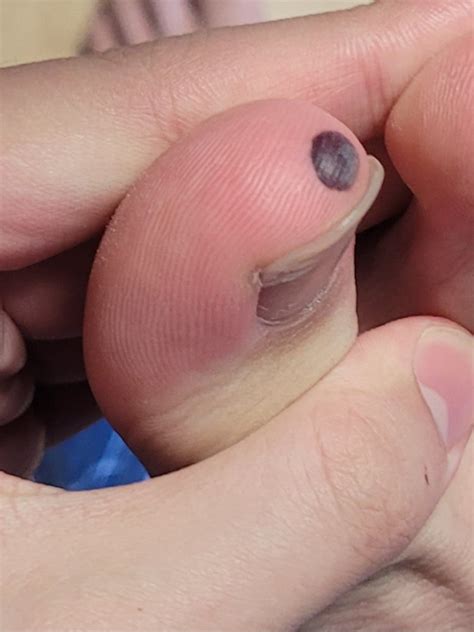 다쳐서 생긴 튀어나온 검은색 점 지식in