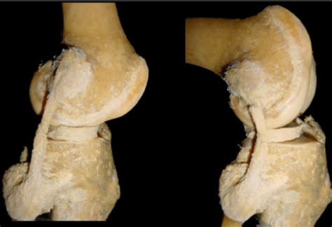 Anteroposterior Translation Of The Lateral Meniscus During Flexion Download Scientific Diagram