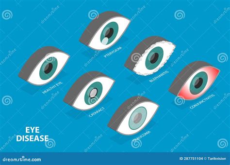 Cataract Pinguecula Glaucoma And Pterygium Eye Care Vector Illustration