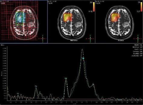 Tumefactive Demyelinating Lesion Eurorad