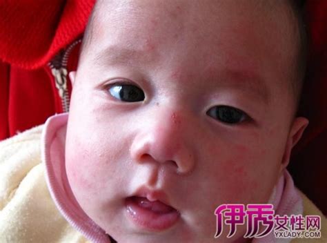 脂溢性皮炎怎么根治 头部脂溢性皮炎偏方 随意云