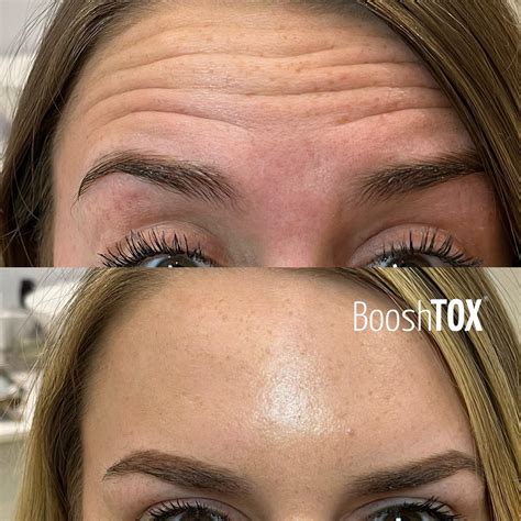 What Is Baby Botox Who Is It For Blog Booshtox