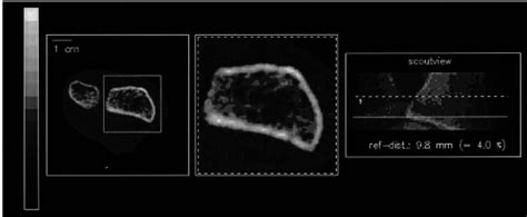 The Ultra Distal Scan Region In Peripheral Quantitative Computed Download Scientific Diagram
